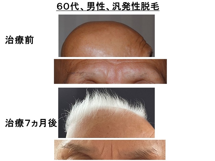 汎発性脱毛の患者様、治療7ヵ月で元気の良い産毛と眉毛が生えてきました！ 患者様からの声・メディア掲載・クリニックからのお知らせ 名古屋k